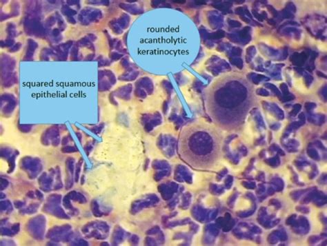 How To Recognize Autoimmune Skin Disease Tips For Spotting Pemphigus