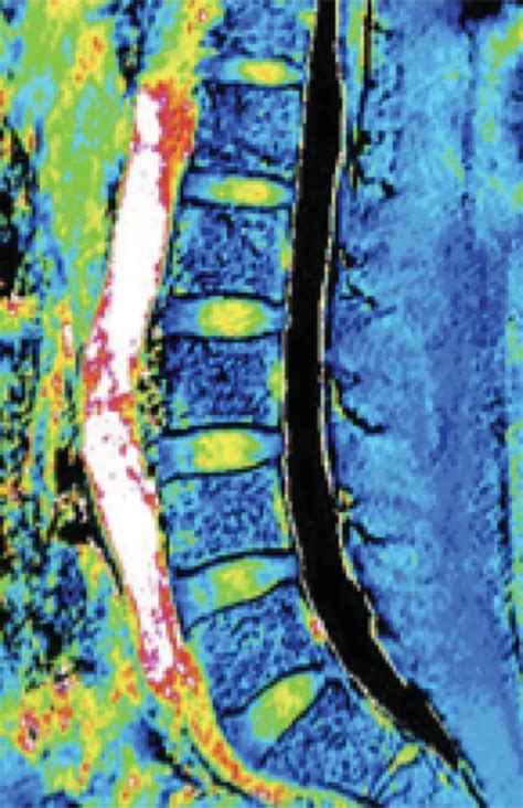 Imaging Diagnosis For Intervertebral Disc Pmc