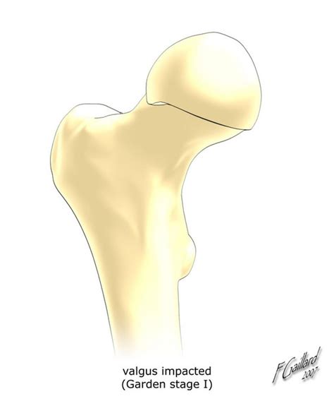 Hanche Classification De Garden Pinkybone