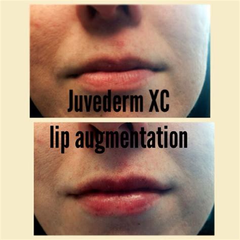 Juvederm Lip Augmentation Lip Augmentation Facial Aesthetics