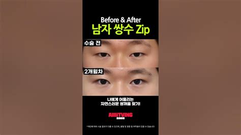 [성형전후] 남자 쌍꺼풀 수술 올리팅성형외과 Shorts 눈수술 성형전후 Youtube