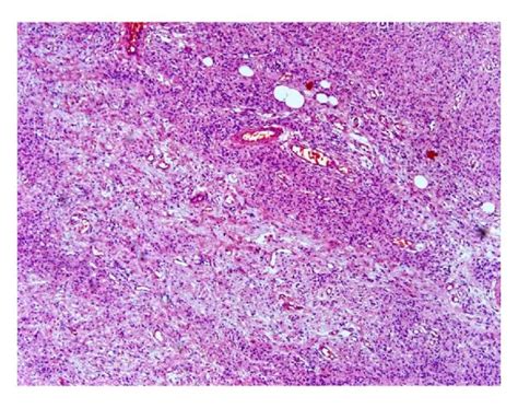 Fibrocellular Connective Tissue Predominantly Elongated Spindle Shaped