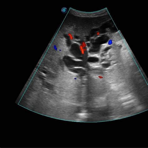 Colour Doppler Shows Dilated Intrahepatic Biliary Tree More On Left Download Scientific Diagram
