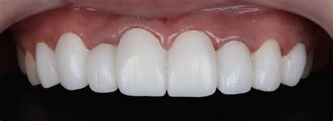 症例フルジルコニアセラミック上顎前歯8本 Arte Dental Clinic