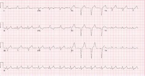 First Formal ECG Depicting Left Bundle Branch Block Done At 36 H Download Scientific Diagram