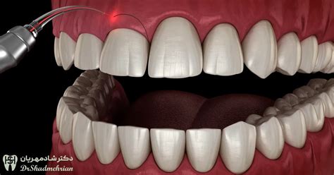 افزایش طول تاج دندان چیست؟ مزایای بالا بردن لثه [سال 1404]