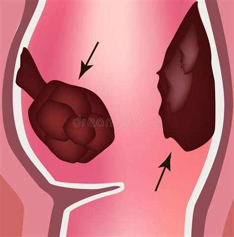 Polyps In The Rectum The Structure Of The Rectum Of The Intestine