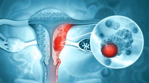 Cáncer Cervicouterino Cuando El “luego” Se Vuelve Mortal Salud180