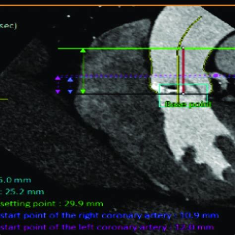 Mitral Annular Calcification Ct Allows Precise Localization Of Mitral Download Scientific