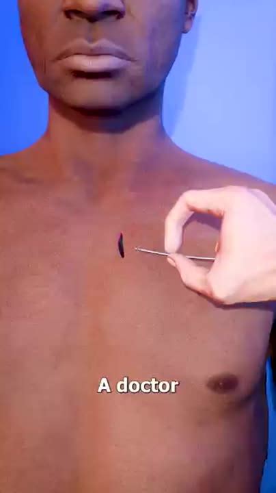 Shazmah Shaikh On Linkedin How Does Pacemaker Work A Pacemaker Is A