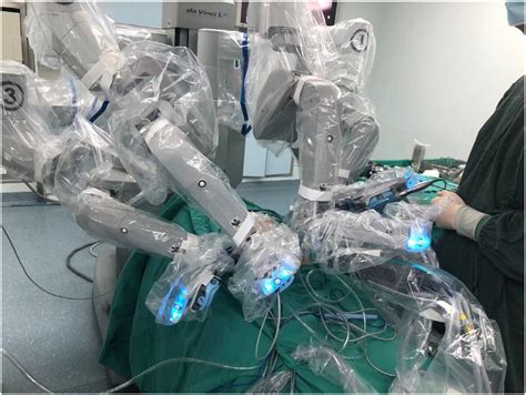 Scheme Of Trocars Robotic Arms And Accessory Trocar For The Assistant