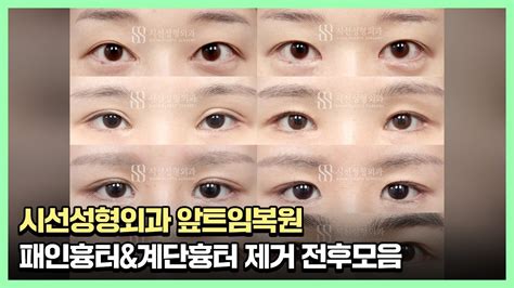 시선성형외과 앞트임복원 패인흉터and계단흉터 제거 전후모음 바로확인 Youtube