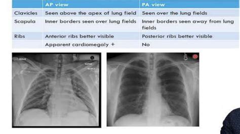 Chest Xray Pathologies Interpretationpptx Lung And Respiratory