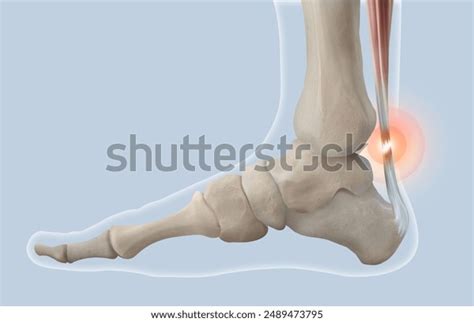 Achilles Tendon Rupture Anatomy Medical Illustrationx Stock