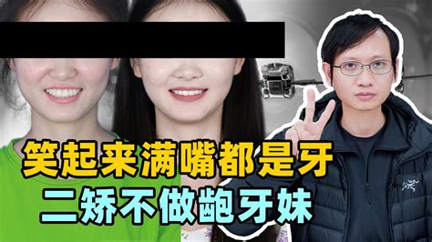 第一次矫正单侧拔牙整成整齐的龅牙二矫不想再做龅牙妹 YouTube