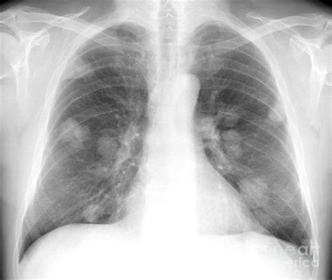 Secondary Lung Cancers X Ray Photograph By Du Cane Medical Imaging Ltd