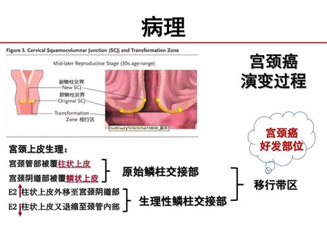 Ppt 子宫颈癌 Cervical Cancer Powerpoint Presentation Free Download
