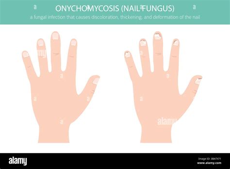 Medical Vector Illustration Of Onychomycosis A Common Fungal Toenail