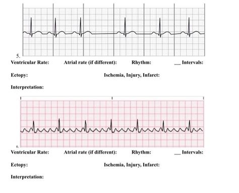 5 Ventricular Rate Ectopy Ischemia Injury Chegg Com