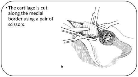 Technique Of Harvesting Cartilage Graft For Cartilage Tympanoplasty