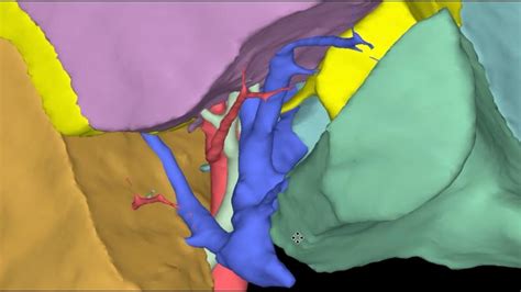 3d Ds Ep 1 Right S9 S10 Segmentectomy Karel Pfeuty 18 Comments