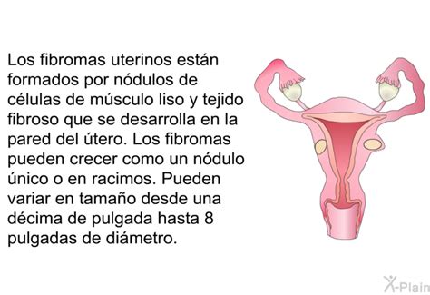 PatEdu Fibromas Uterinos