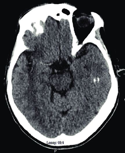 Initial Axial Noncontrast Head Computed Tomography Demonstrating A