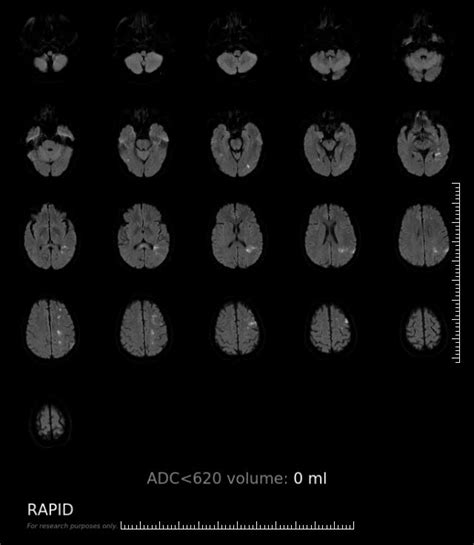 Figure A1 ADC Map Of A Patient Download Scientific Diagram