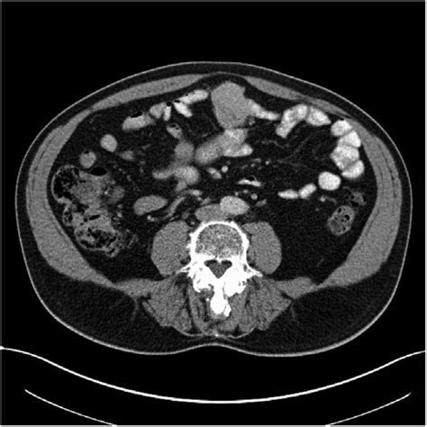 Sagittal View Of Ct Ap Showing 45 Cm Lobulated Mass In The Anterior