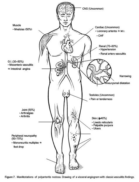 Rheumaknowledgy Polyarteritis Nodosa