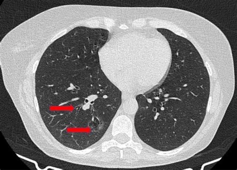 Uniportal Vats Anatomic Right Basal Segmentectomy S7 10 Ctsnet