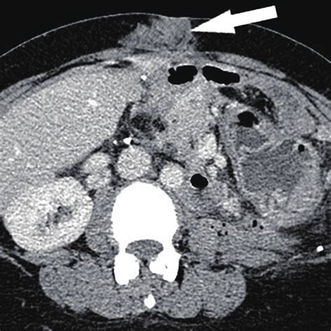 Computed Tomography Ct Of Abdomenpelvis In 2017 Demonstrating