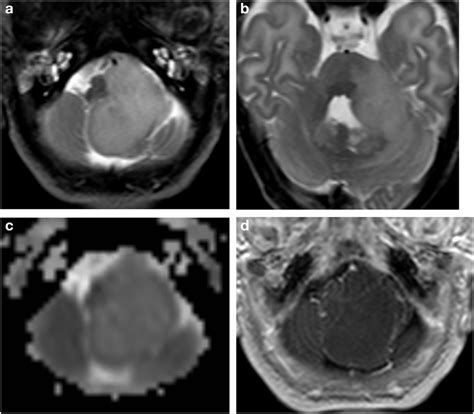 Brain Mri Axial T2w Ab Adc Map C And Gd T1w D Images Extensive