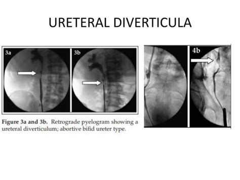 Retrograde Pyelography Pptx Digestive Disorders Diseases And