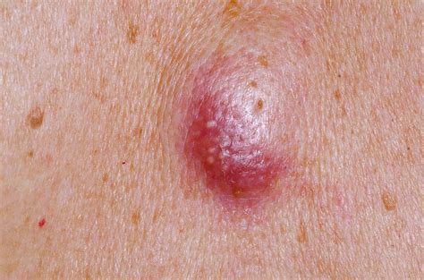 Infected Sebaceous Cyst Photograph By Dr P Marazziscience Photo Library
