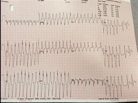 Vt Or Svt Case I Saw In The Hospital R Ekgs