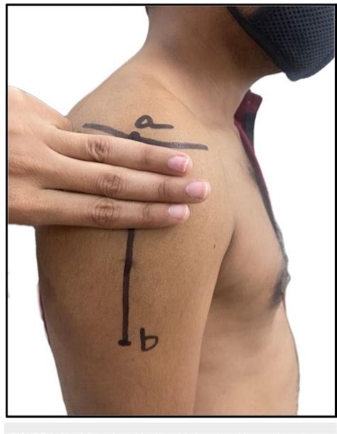 Figure 6 Deltoid Intramuscular Injections A Systematic