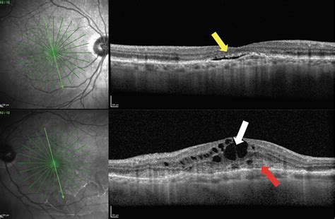 OCT An Indispensable Tool In Retina Care