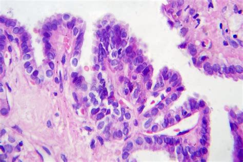 Micrografía De La Luz Del Cáncer De Tiroides Papilar Foto de archivo