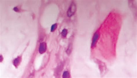 Dehydrated Amnion Chorion Membranes For Periodontal And Alveolar