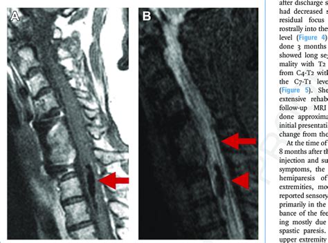 Sagittal T1 Weighted A And Short Tau Inversion Recovery B Magnetic