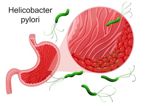 Helicobacter Pylori En Células Epiteliales Del Estómago Bajo