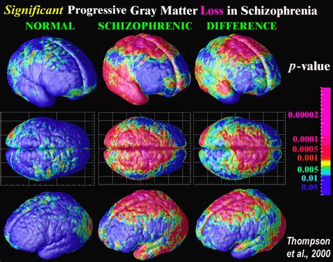 Schizophrenia Fact And Schizophrenia Statistics