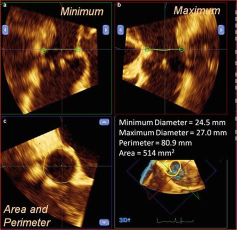 Echocardiographic Evaluation Of Aortic Valve Stenosis Thoracic Key