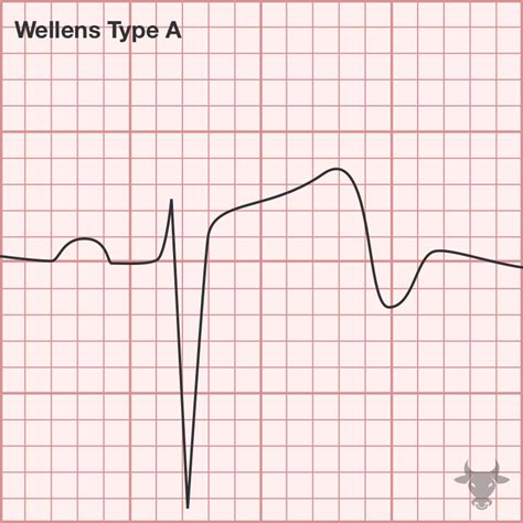 Wellens Syndrome Ecg Stampede