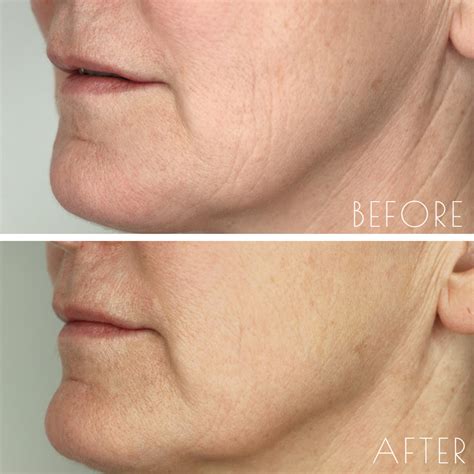 Miracle Creme With Egf Epidermal Growth Factor Moisturizersspf