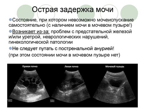 Неотложная радиология в урологии Почечная колика Online Presentation
