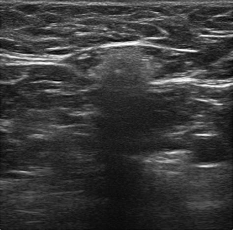 Extracapsular Silicone Implant Rupture In A Woman With A History Of