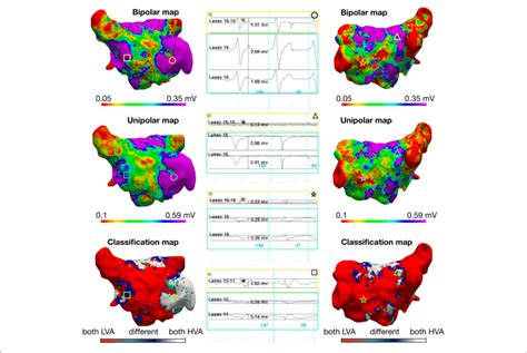 voltage mapping in atrial fibrillation three dimensional