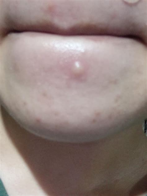 How Do I Get Rid Of This Big Pimple That Just Wont Go Away R